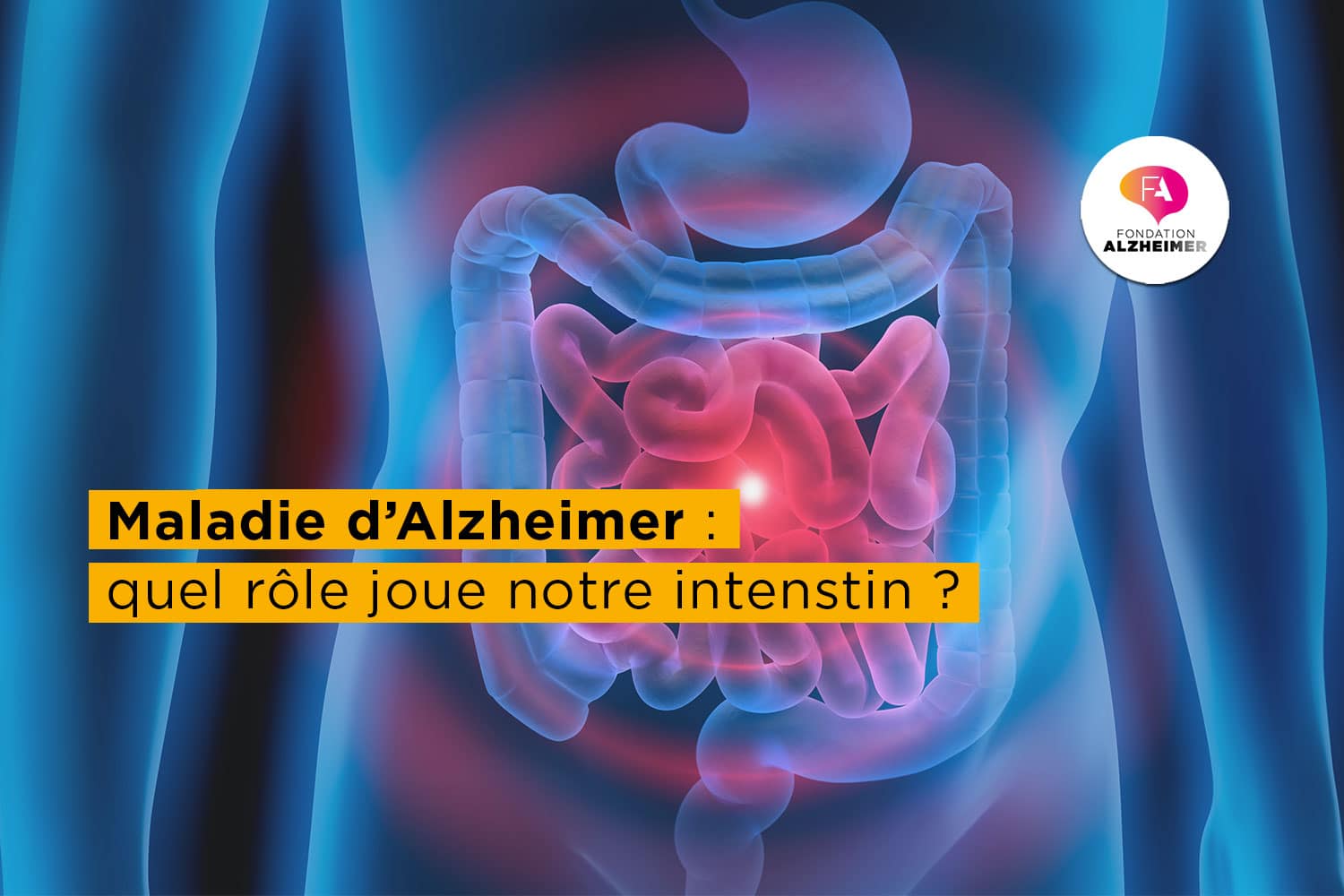 Qu'est-ce qu'une plaque amyloïde ? - Fondation Alzheimer